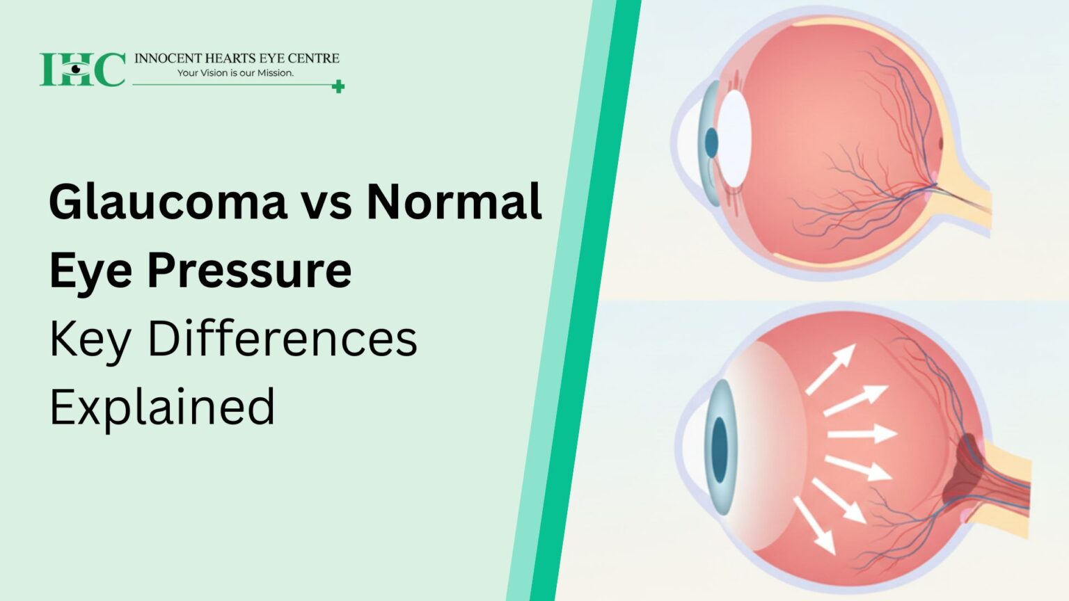 Glaucoma vs Normal Eye Pressure: Key Signs, Symptoms & Early Detection
